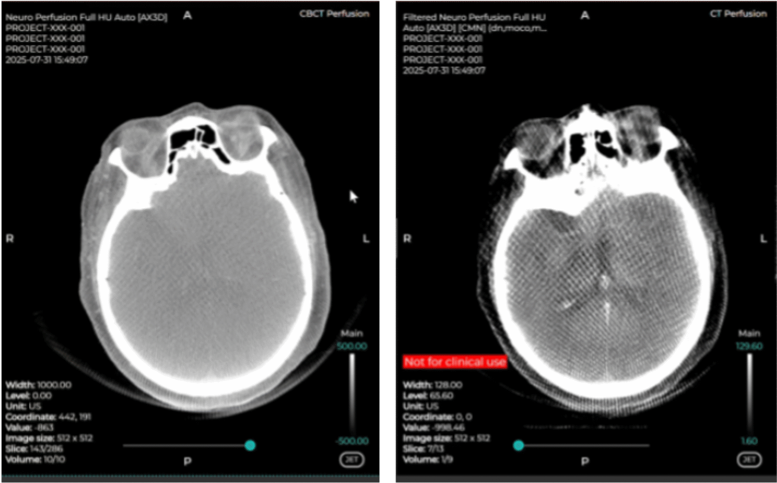 Cercare Medical Releases Version 17 of Neurosuite: Advancing Precision ...